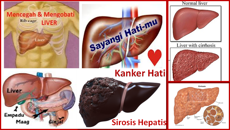 XAMTHONE PLUS SURABAYA: Artikel Media Alkoholisme Berujung Sirosis Hepatis