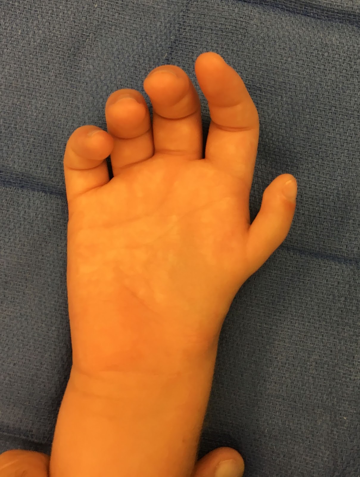 Patient Pollicization Testimonial | Congenital Hand and Arm Differences ...