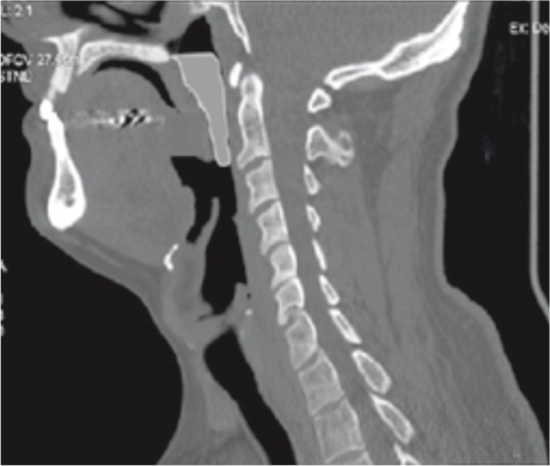 Ronquido y apnea del sueño en niños | Otorrino Insiders