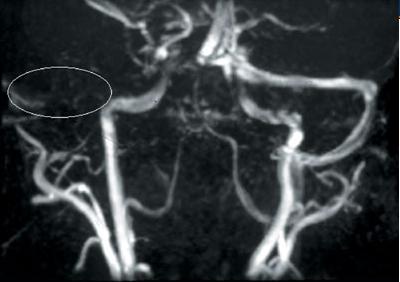 ABC Radiology Blog: Bezold Abscess