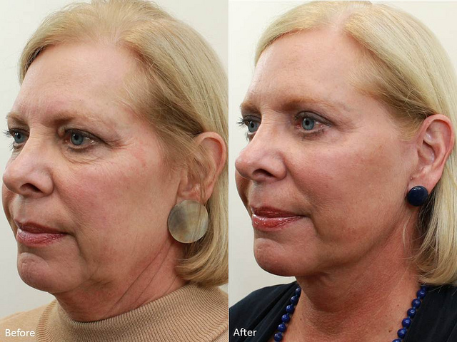 Dr. Darm, Aesthetic Medicine Blog: Natural-look facelift before and ...