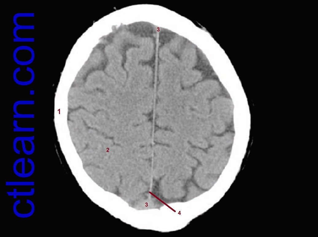 Anatomy CT Axial Brain