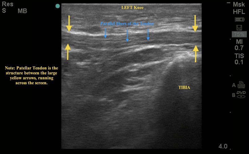 Patellar Tendon Rupture ~ Ultrasound Cases Info