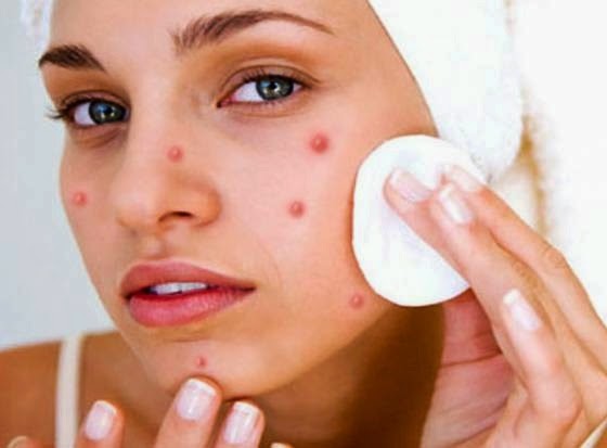 How to Get Rid of Pimples Fast-Methods to Apply ~ Get Rid of Pimples or Zit