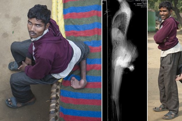 Photos: Indian Man Born With 4 Legs Begs Doctors To Amputate Extra ...