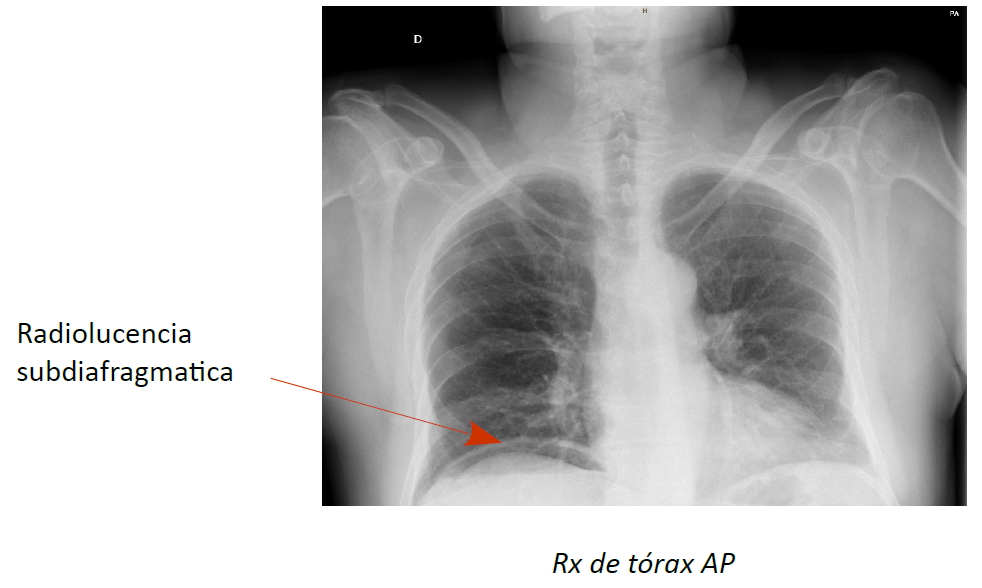 El Blog de Isa y Juan: Neumoperitoneo