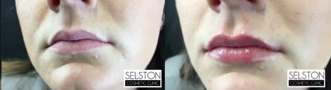 Selston Cosmetic Clinic: Add Volume With Lip Filler Treatment at ...