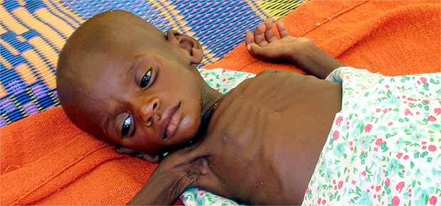 Insegurança Alimentar na Área Urbana e Área Rural: Desnutrição: o cume ...