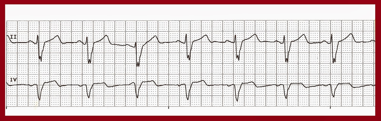 Various Normal Sinus Rhythms