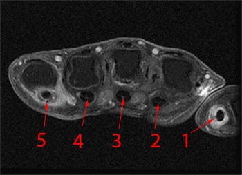 MRI Musculo-Skeletal Section: Classic horseshoe abscess.