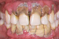 Ciri-ciri Karang Gigi Yang Menyebabkan Gigi Goyang, Bagaimana Proses ...