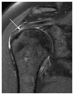 MRI Musculo-Skeletal Section: Partial thickness tear