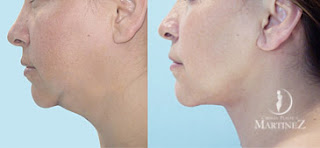 En qué consiste una cirugía de papada - Cirugía Plástica Martínez