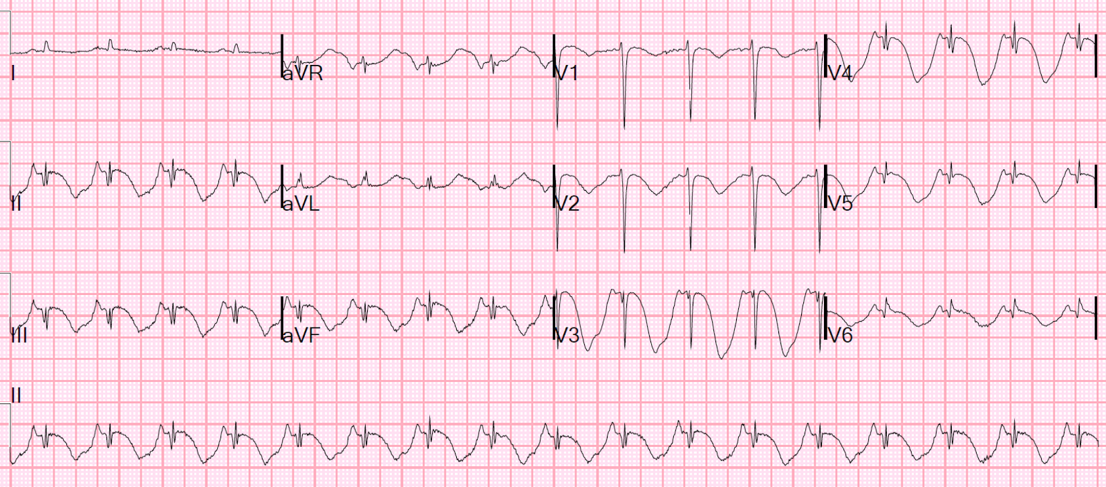 Dr. Smith's ECG Blog: Central Nervous System T-waves