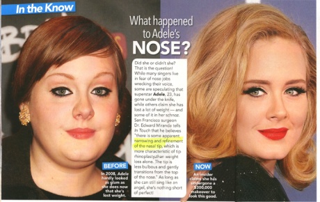 Adele Nose Job Before and After Plastic Surgery Photos - Star Plastic Surgery | Star Comestic ...