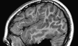 Polymicrogyria-Mayo Radiology