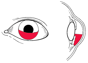 Anterior Segment Damage In Contusion Eye Injury : Sight Medical Blog