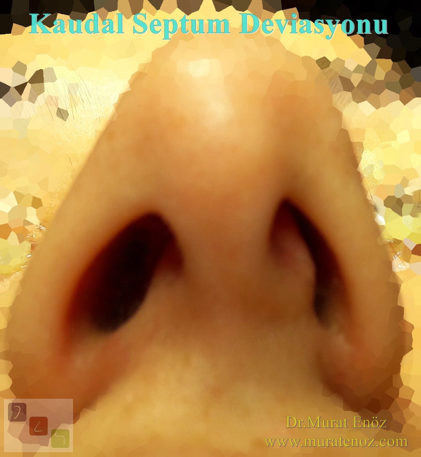 Kaudal Septum Deviasyonu