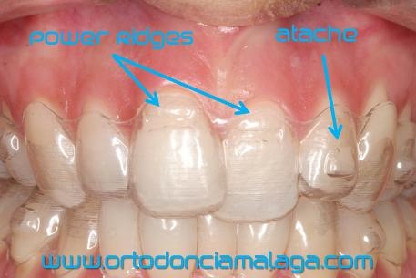 My Invisalign Journey: January 2013