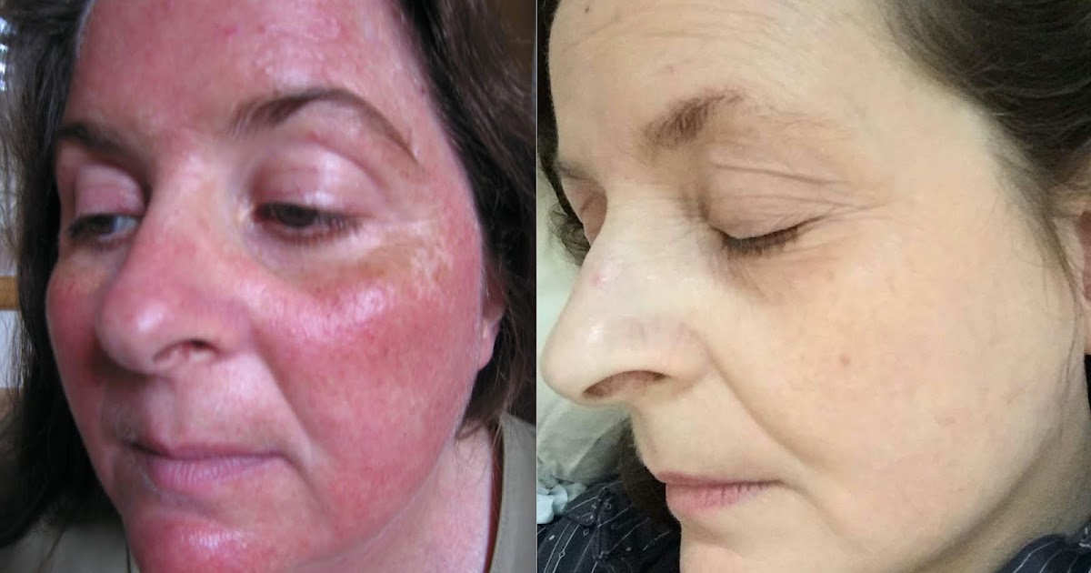 Rosácea Acne: diagnóstico, tratamento cirúrgico, cosmético e prevenção