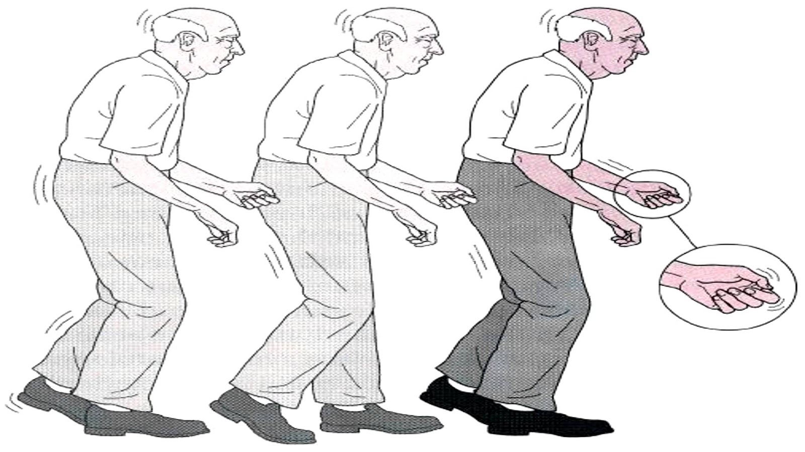 Fisioterapia Inovadora: RESUMO SOBRE A DOENÇA DE PARKINSON – TRATAMENTO