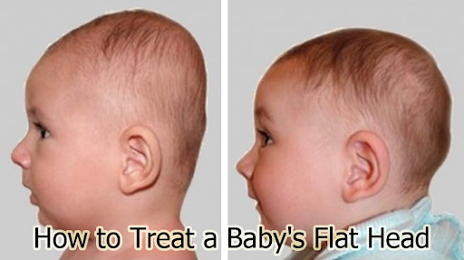 How to Treat a Baby's Flat Head