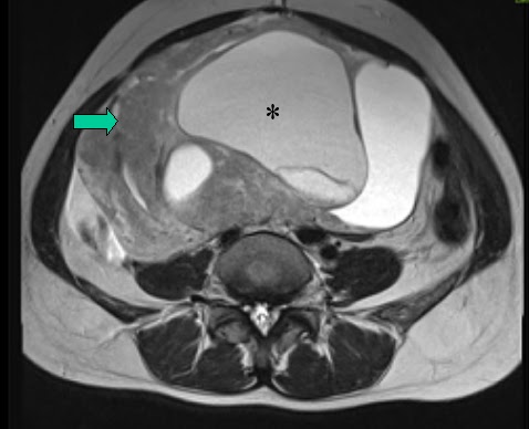mricases: Large Degenerative Hemorrhagic Sessile Subserosal Uterine Fibroid