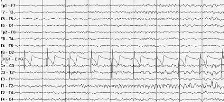 MCQ. Electoencephalography (EEG) ~ Nursing Path