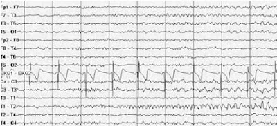 MCQ. Electoencephalography (EEG) ~ Nursing Path