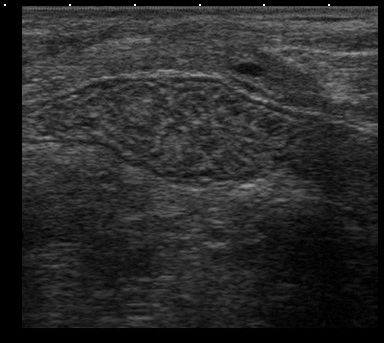 O Radiologista: Aderência Intestinal - Ultrassonografia