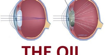 THE OIL THAT IMPROVES VISION AND REMOVES CATARACTS (HOW TO USE IT ...