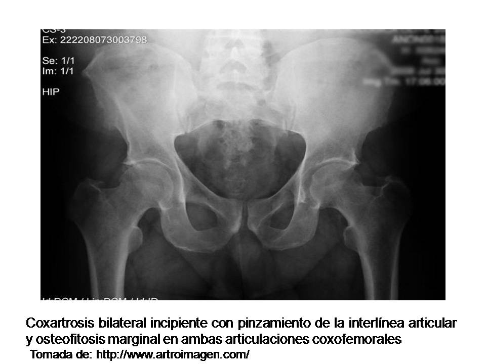 Diagnóstico de la artrosis