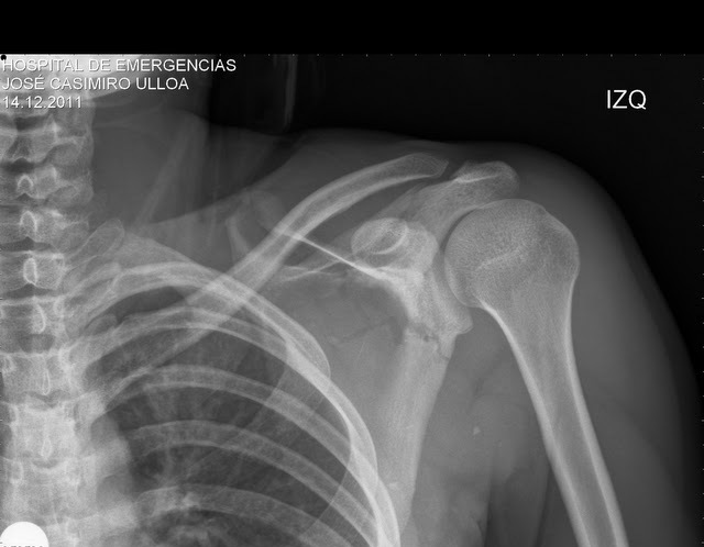 CASIMIRO RADIACTIVO: PASEANDO POR RAYOS X