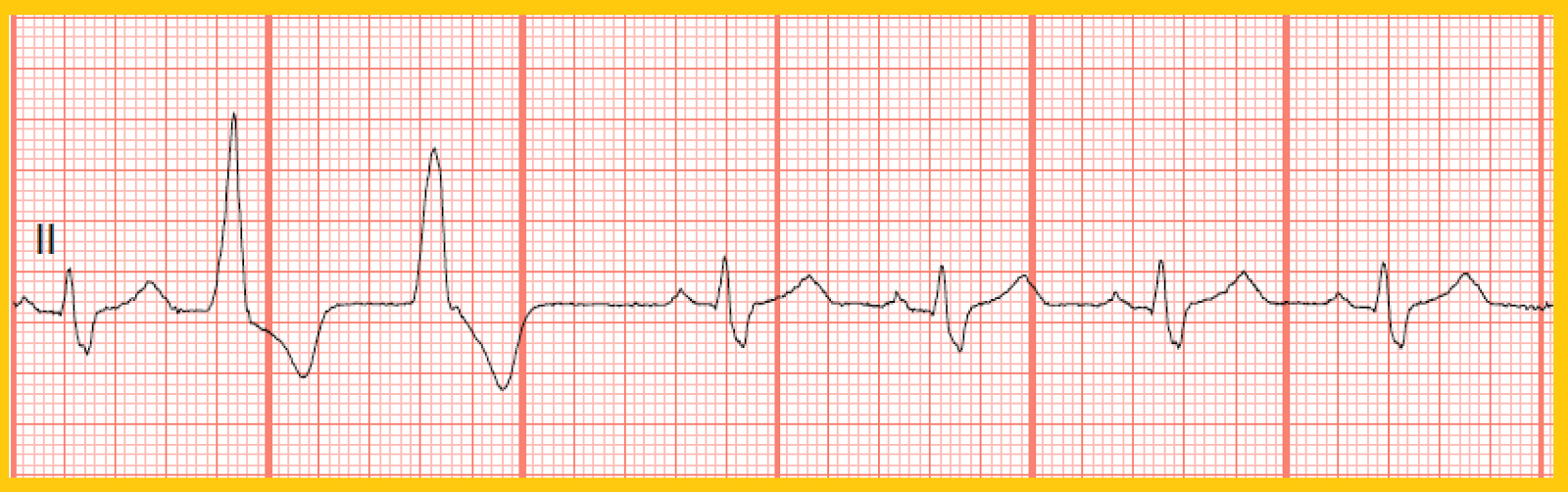 Practice Rhythm Strips 281