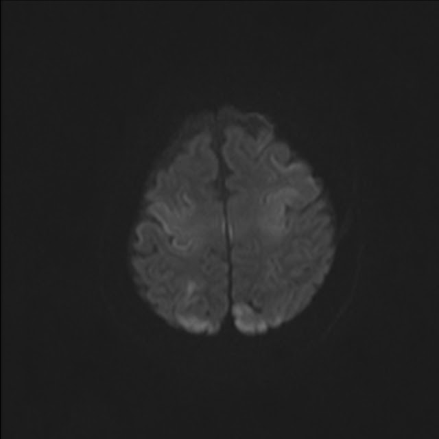 Ultimate Radiology : Hypoxic-Ischemic Brain Injury in a post cardiac ...