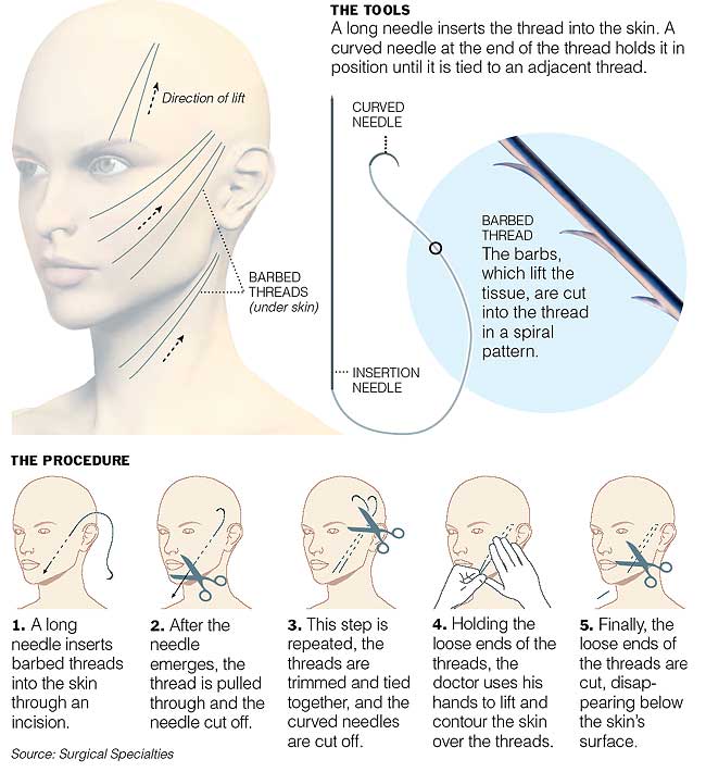 Eyelid Surgery by Prof Dr CN CHUA 蔡鐘能: A Phoney Surgeon on the Loose
