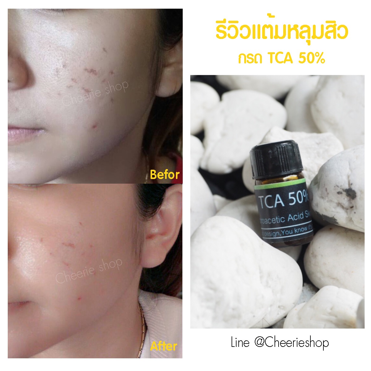 กรดTCA 100% 50% ใช้อย่างไร ให้เกิดประโยชน์ ไม่นำโทษมาให้เคืองใจ