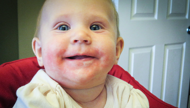 top care : What does nappy rash look like?