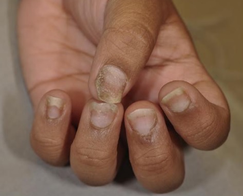Nail pitting: Nail Pitting California