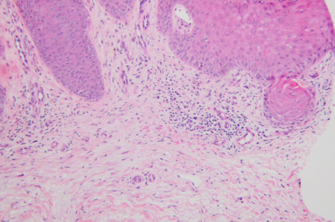 Consultations in Dermatoscopy: Pink and Purple