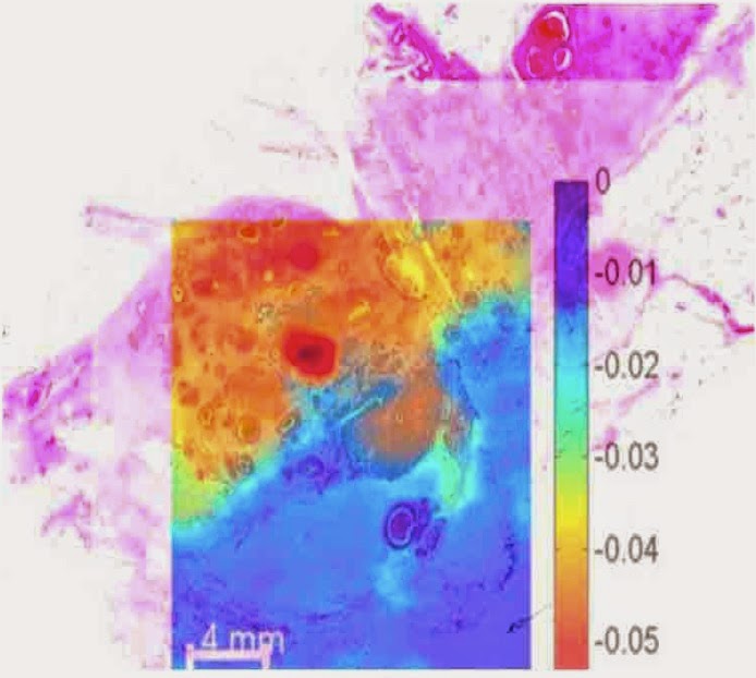 Terahertz Imaging Of Breast Tumours