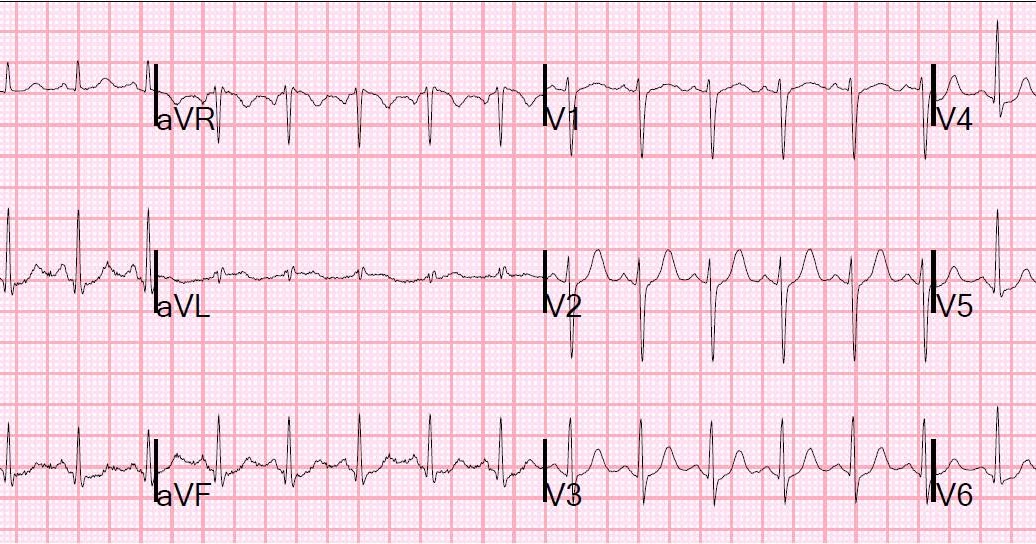 Dr. Smith's ECG Blog: K. Wang Video: the Atrial Repolarization Wave (Ta ...