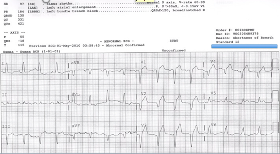 New Left Bundle Branch Block (LBBB) and Dyspnea - Emergency Medicine ...