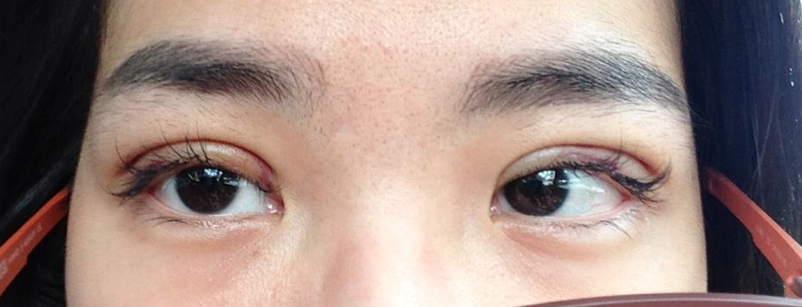 Karen Kho: 我的雙眼皮 (My Double Eyelid Stitching Experience)