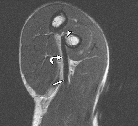 MRI Musculo-Skeletal Section: Biceps injury