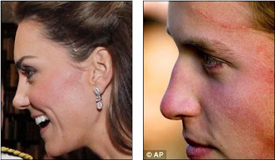 The truth behind Kate's scar: Duchess was 'hit on the head during a ...