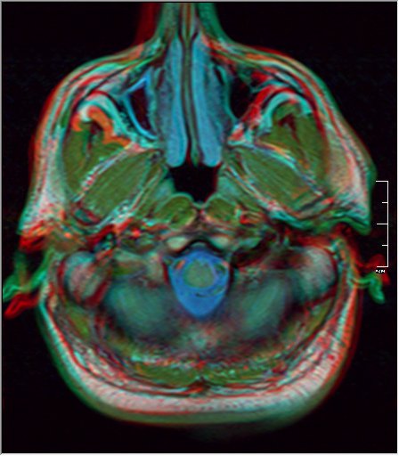 Nevit's blog: Motion atrifacts, Color Brain MRI