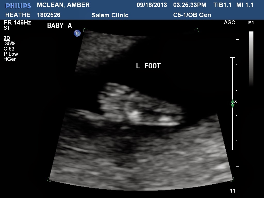 Old Lady and No Baby: 20 Week Anatomy Scan