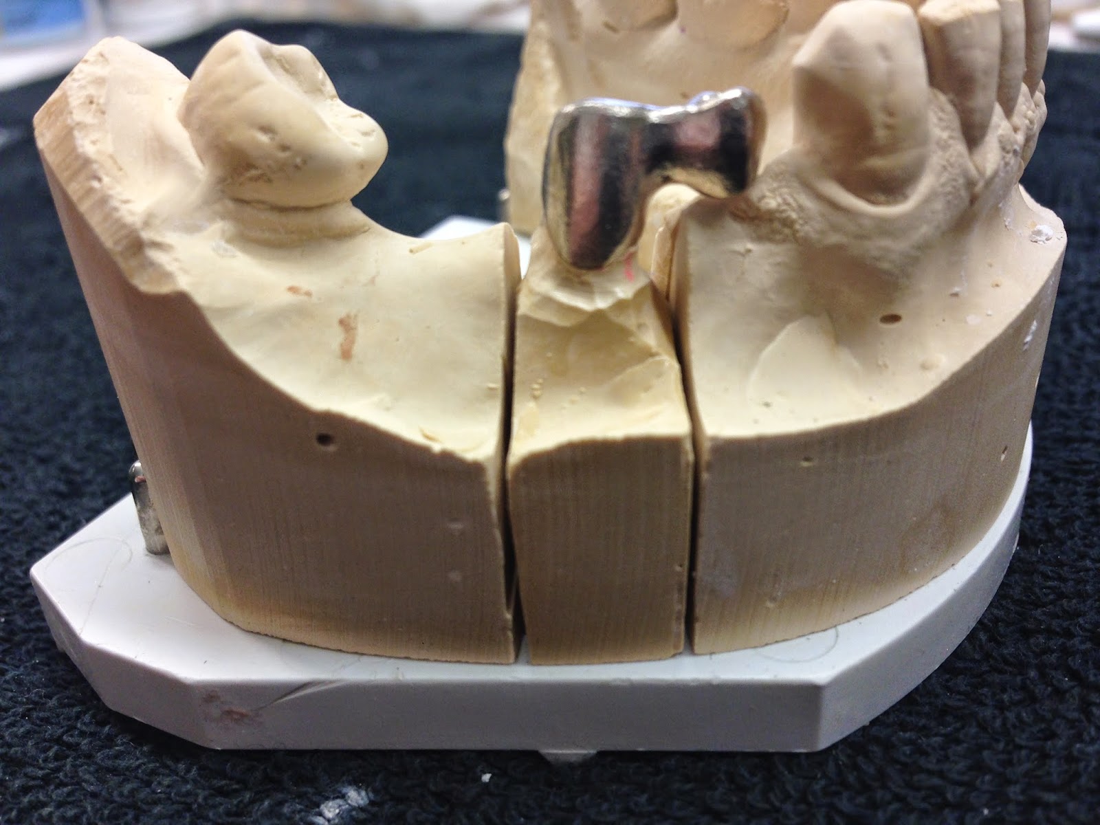 Zahnmedizin und Technik: Die Zirkon Krone oder VMK Krone