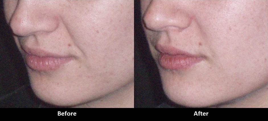 Dr. Alex's Blog: Descent of the cheek fat pad